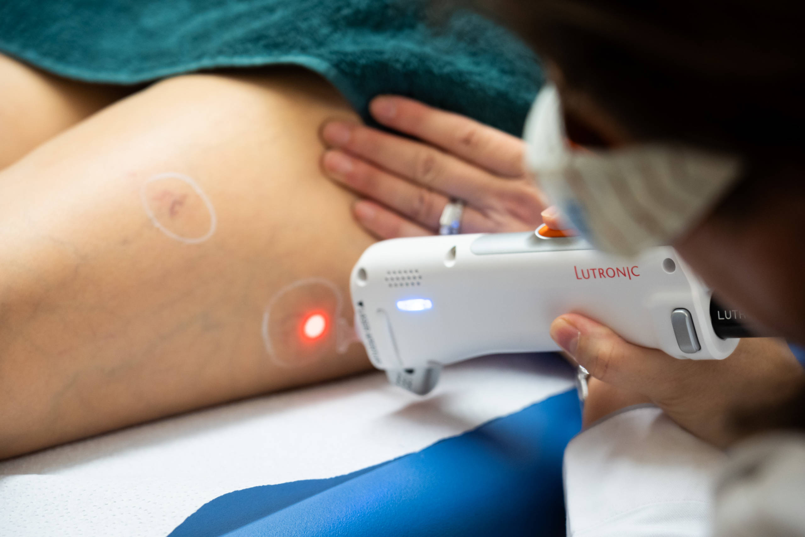 Laser vasculaire – Tanit Dermacare